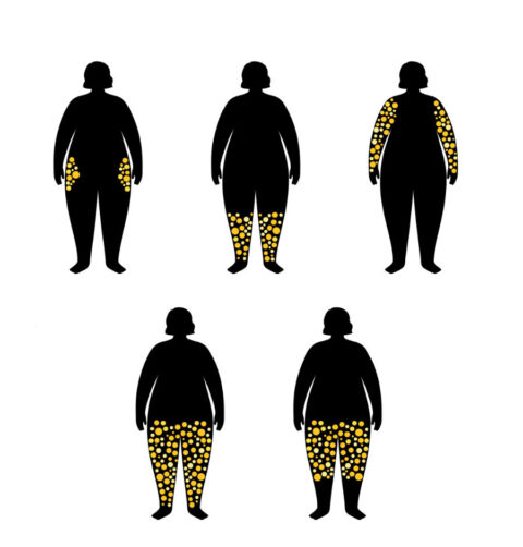 Lipedema | Lipedema Diagnosis and Treatment | Seattle, WA | Lipedema ...
